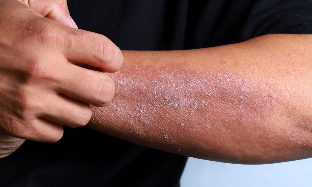 Alergia al sol: síntomas y tratamiento eficaz | Blog